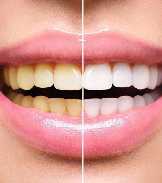 How Do Teeth Stain & Get Rid of Badly Stained Teeth | Expert Tips