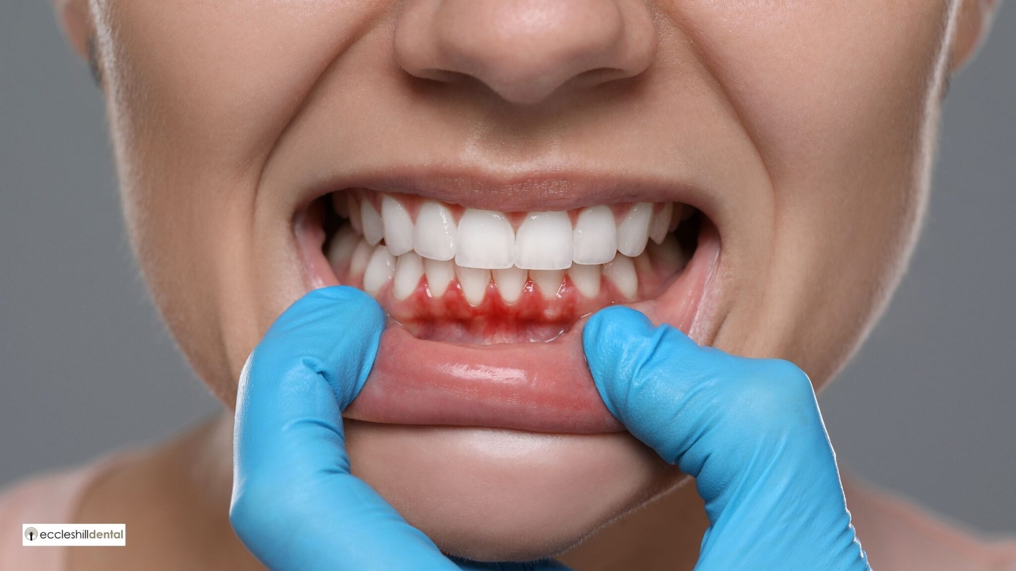 Gum Abscess Treatment in Bradford | Private Dental Clinic